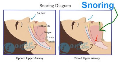 11 PROVEN Remedies On How To Stop Snoring Naturally Tonight